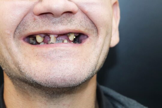 Dents Pourries : Symptômes, Causes Et Remèdes - Dousopal